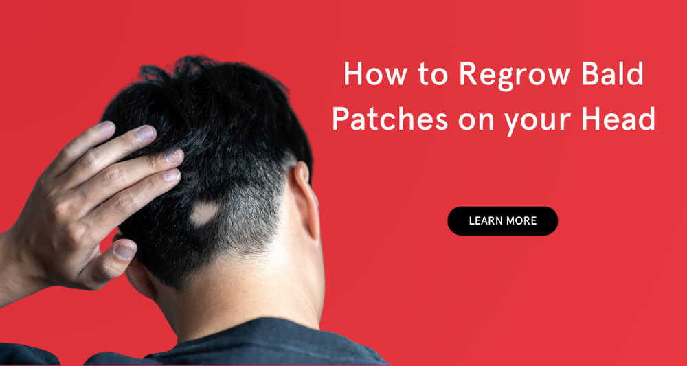How to Regrow Bald Patches on your Head